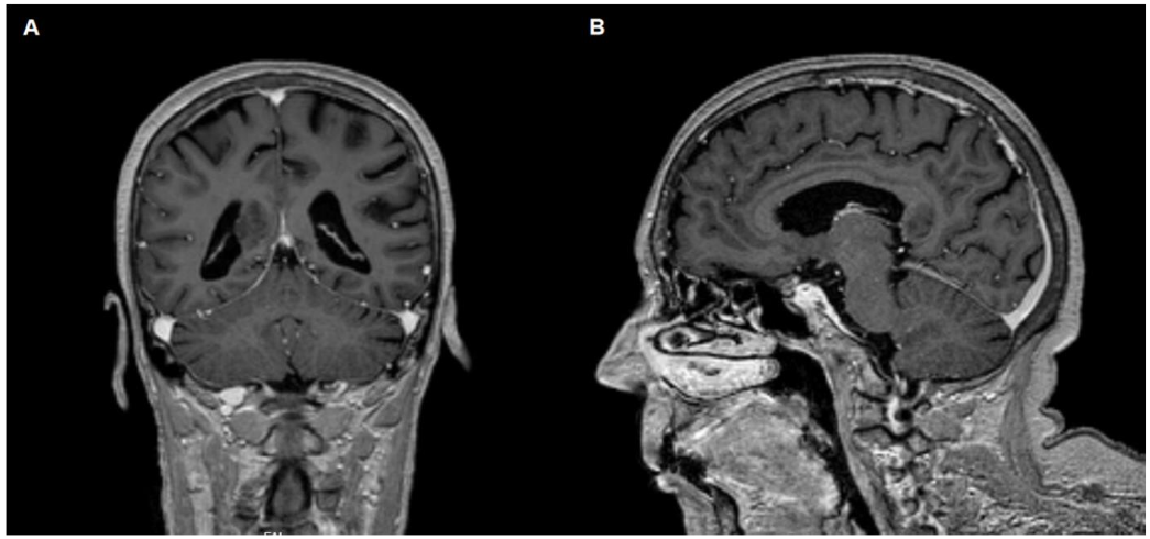 Acute Splenial Hemianopsia: Case Report and Insights - European Society ...