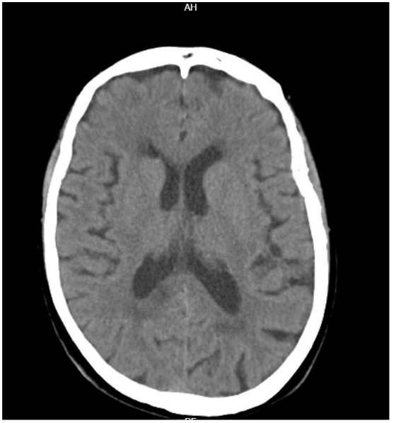 Acute Splenial Hemianopsia: Case Report and Insights - European Society ...