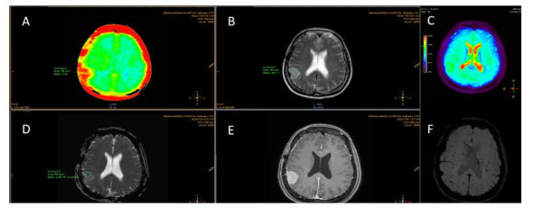 APT MRI in Meningioma Grading: A Study of Correlation - European ...