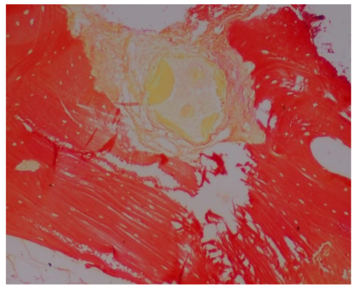 Autogenous Tooth-Derived Grafts in Bone Regeneration - European Society ...