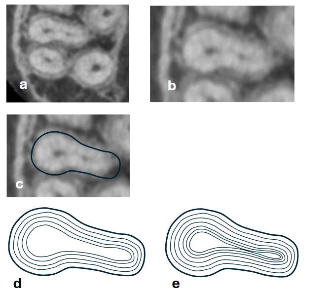Cone-Beam CT Analysis of Maxillary Molar Canals - European Society of ...
