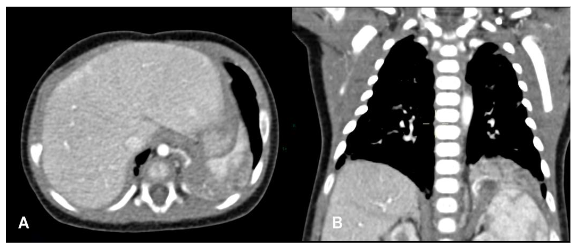 Congenital Pulmonary Malformations: Insights and Risks - European ...