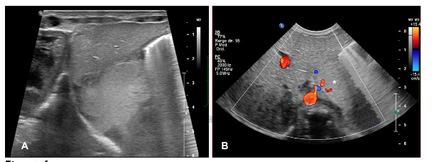 Congenital Pulmonary Malformations: Insights and Risks - European ...