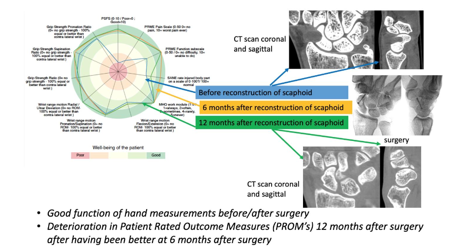 Consensus Tool for Measuring Hand and Wrist Outcomes - European Society ...
