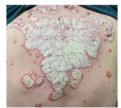 Cutaneous Manifestations of Non-Neoplastic Bowel Diseases - European ...