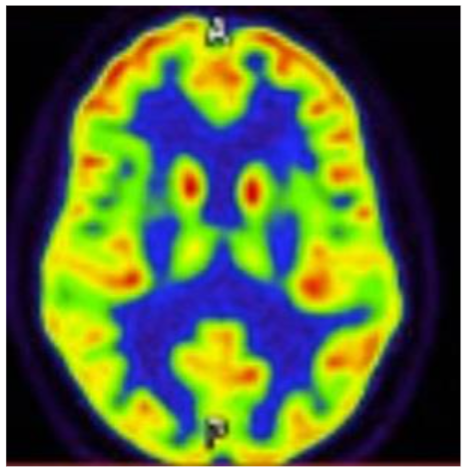 Early-Onset Dementia with Lewy Bodies and PRKN Mutation - European ...