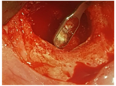 Endodontic Microsurgery for Maxillary Root Cyst Repair - European ...