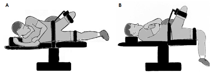 Hip Muscle Geometry After Transfemoral Amputation - European Society of ...