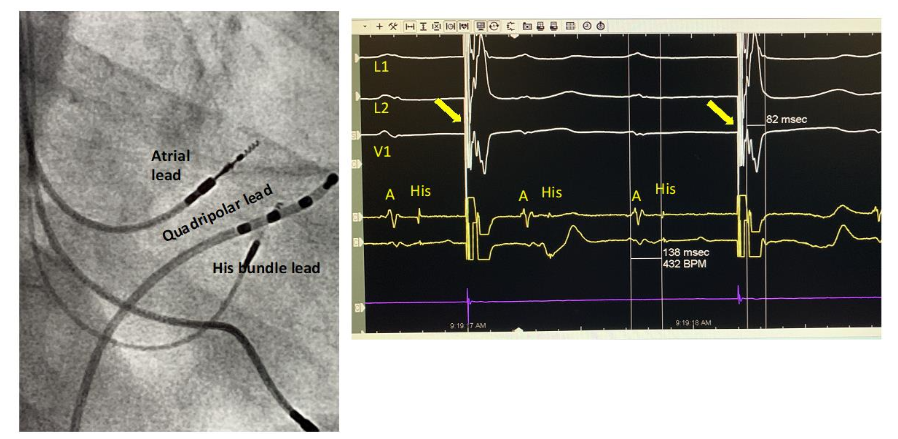 His Bundle Pacing: Improving Outcomes in Cardiac Care - European ...