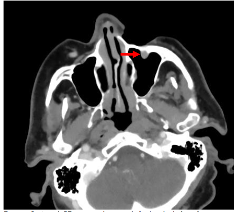 Imaging Skin Lesions: CT, MRI, Ultrasound, and PET Insights - European ...