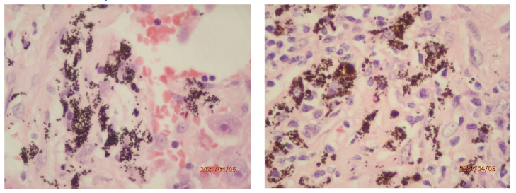 Impact of Biomass Smoke on Pneumonia Morbidity in Japan - European ...