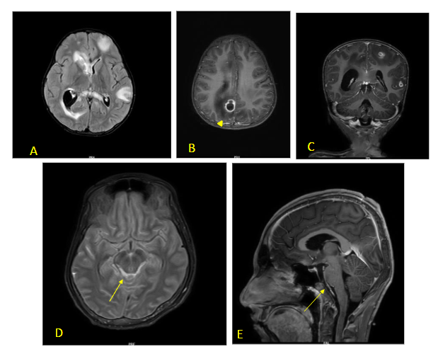 Infection Triggered Encephalopathy Syndromes in Children - European ...