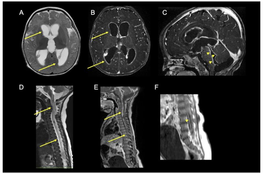 Infection Triggered Encephalopathy Syndromes in Children - European ...
