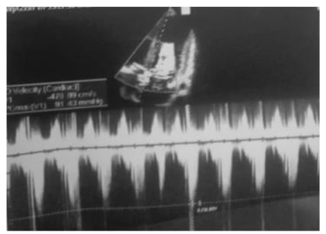 Infective Endocarditis and Cerebral Mycotic Aneurysm in HCM - European ...