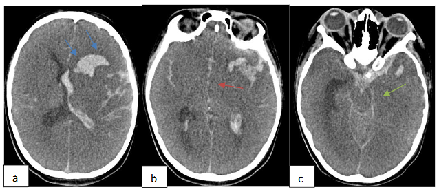 Infective Endocarditis and Cerebral Mycotic Aneurysm in HCM - European ...