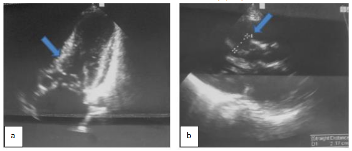 Infective Endocarditis and Cerebral Mycotic Aneurysm in HCM - European ...