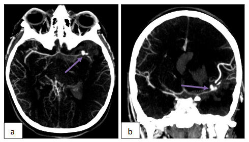 Infective Endocarditis and Cerebral Mycotic Aneurysm in HCM - European ...
