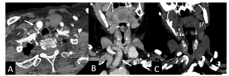 Innominate Artery Dissection: Acute Stroke Case Study - European ...