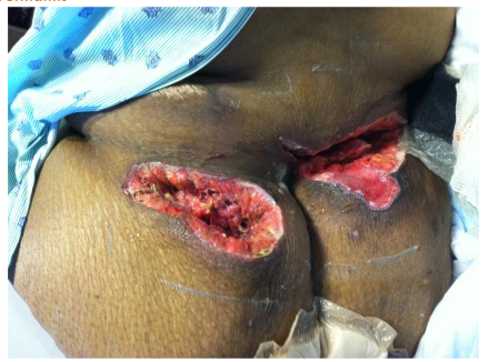 Intertriginous Dermatitis: Causes, Risks, and Management - European ...