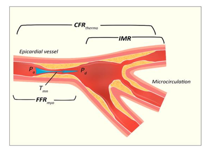 Invasive Evaluation of Coronary Microvasculature in AMI - European ...