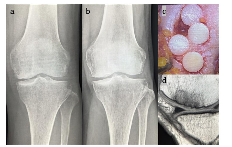 Long-Term Outcomes of Mosaicplasty for Knee SONK - European Society of ...