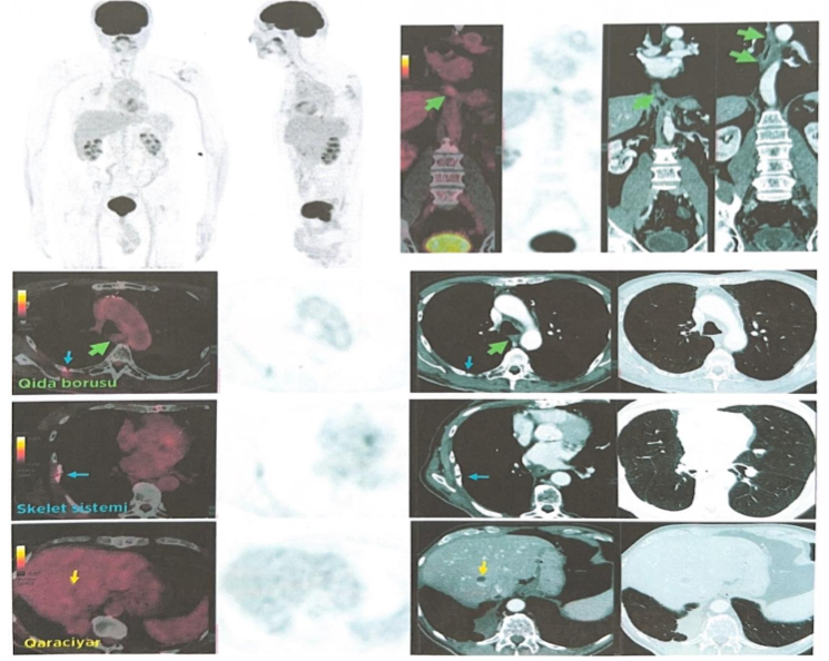 Long-Term Survival in NSCLC with Dual EGFR Mutations - European Society ...