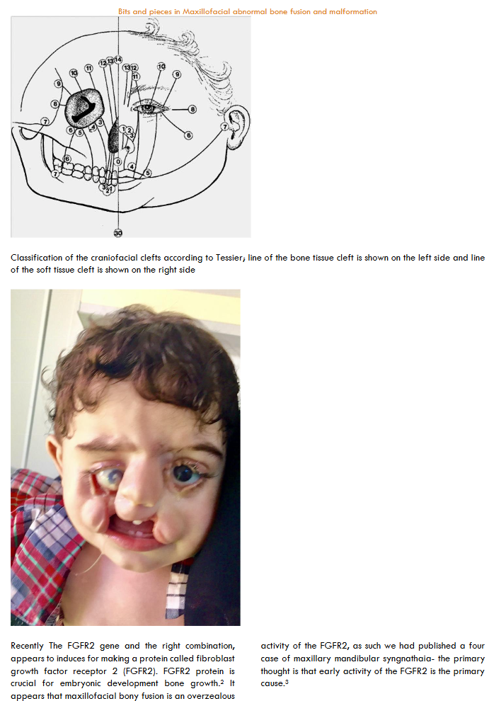 Maxillofacial Abnormal Bone Fusion: Surgical Insights - European ...