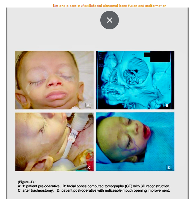 Maxillofacial Abnormal Bone Fusion: Surgical Insights - European ...