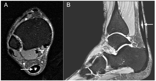 Minimally Invasive Treatment for Achilles Tendon Tears - European ...
