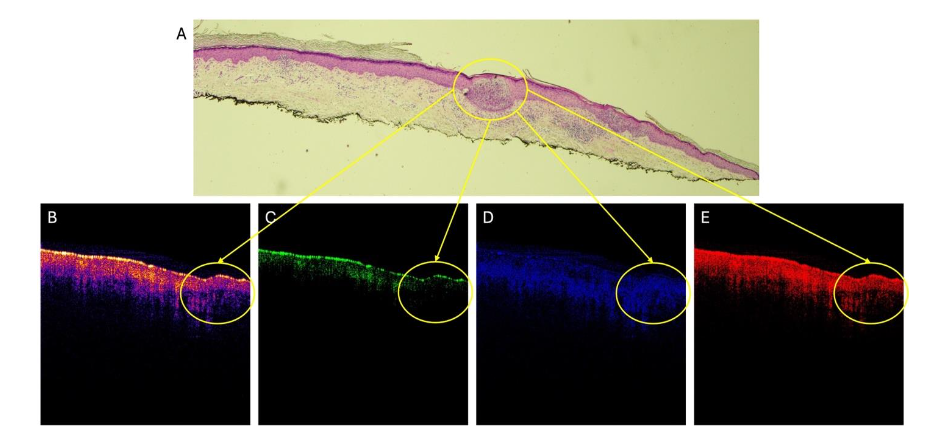 Noninvasive Skin Cancer Classification via VOCT and OCT - European ...