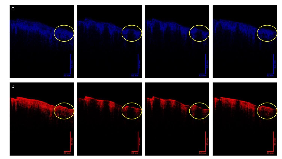 Noninvasive Skin Cancer Classification via VOCT and OCT - European ...