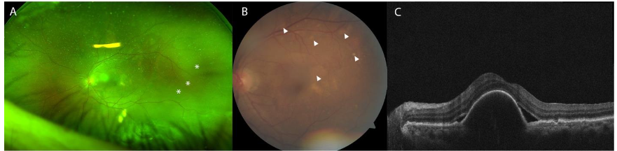 Ocular Tuberculosis: Diagnosis and Treatment Insights - European ...