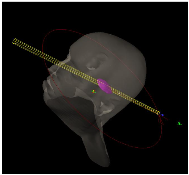 Perturbation Analysis in Cerebellum Stereotactic Radiosurgery ...