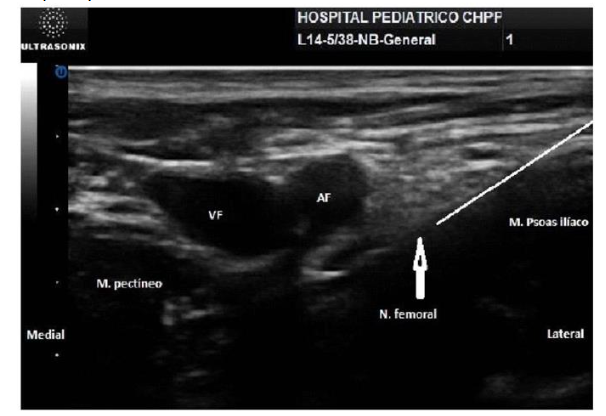 Regional Anesthesia in Neonates: Benefits and Safety - European Society ...
