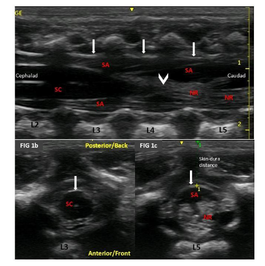 Regional Anesthesia in Neonates: Benefits and Safety - European Society ...