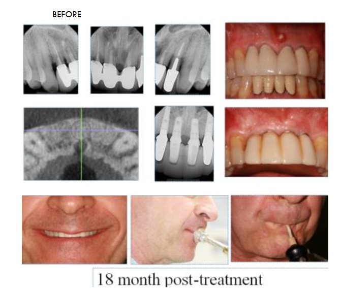 Restoring Function in the Aesthetic Zone: Case Study - European Society ...