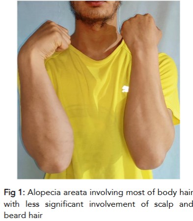 Revising Alopecia Areata Classification and Scoring - European Society ...