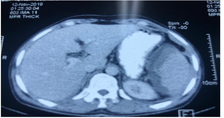 Role of Splenectomy in Malaria Splenic Rupture Case Report - European ...