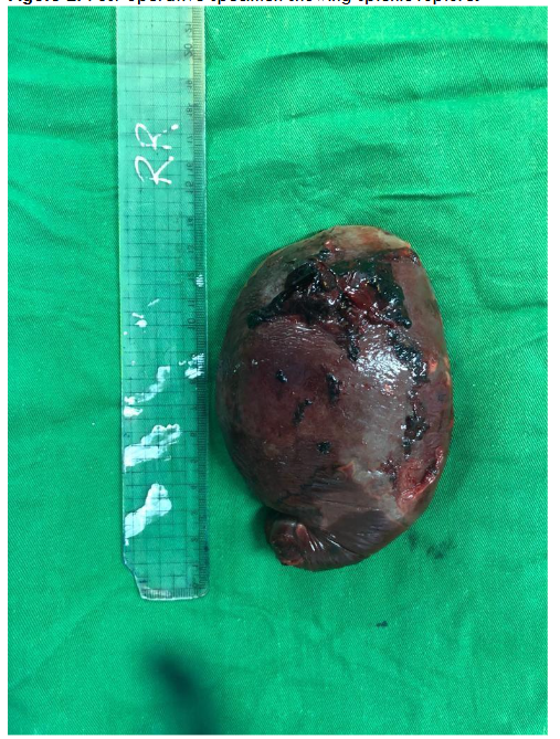 Role of Splenectomy in Malaria Splenic Rupture Case Report - European ...