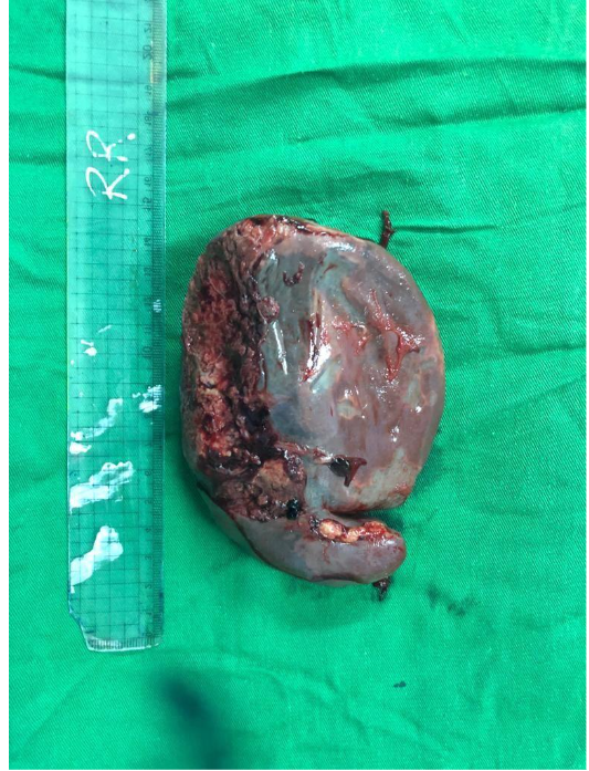 Role of Splenectomy in Malaria Splenic Rupture Case Report - European ...