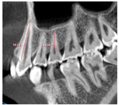 Root Canal Treatment Before Extraction in Orthodontics - European ...