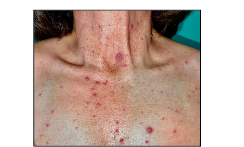Sweet’s Syndrome: Clinical and Histological Updates - European Society ...