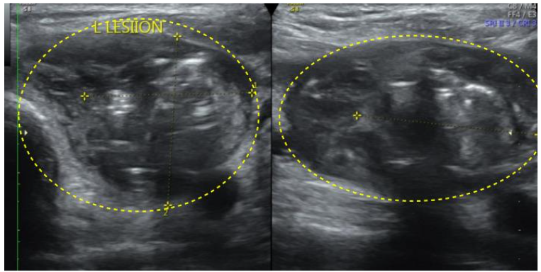 Thyroid Abscess with Medullary Carcinoma: A Rare Case - European ...