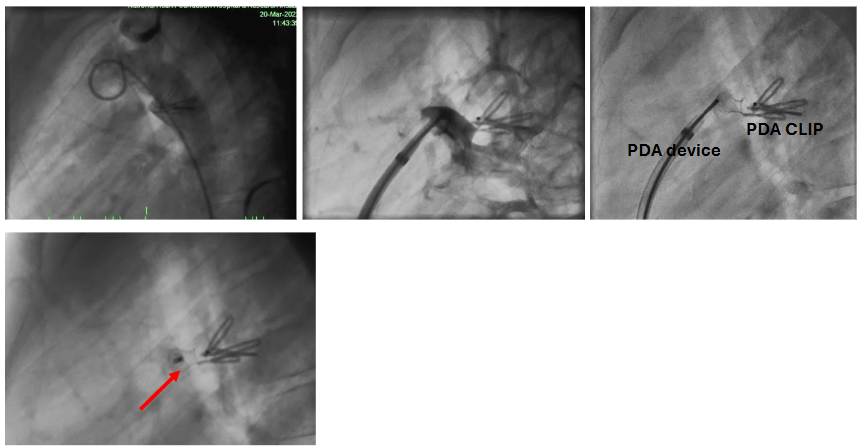 Transcatheter Management of Postoperative Shunt Lesions - European ...