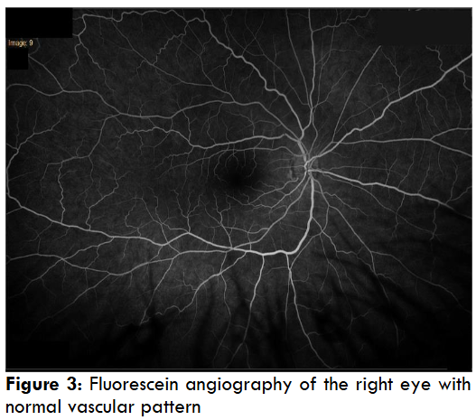 Traumatic Central Serous Chorioretinopathy Case Report - European ...