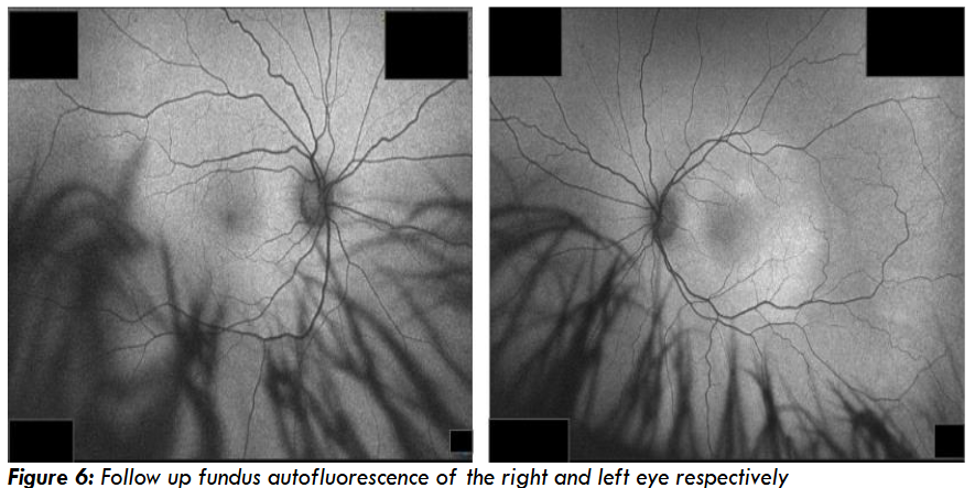 Traumatic Central Serous Chorioretinopathy Case Report - European ...
