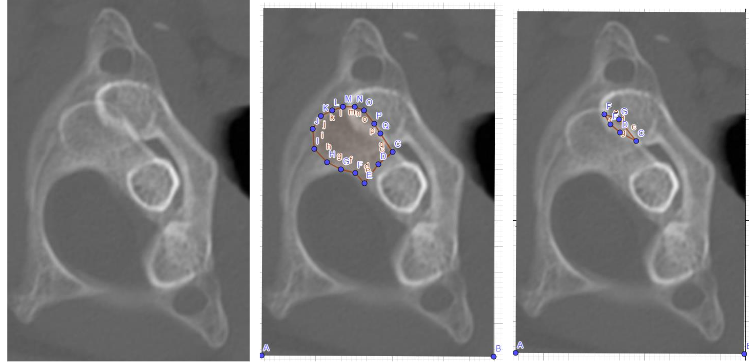 Vertebral Artery Entrapment during Cervical Rotation - European Society ...