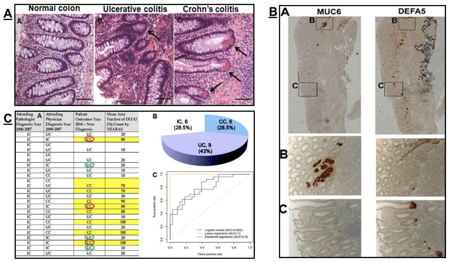 Colonic ileal metaplasia and DEFA5 expansion circumvent indeterminate ...