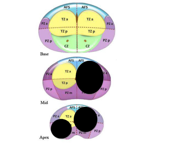 Detecting Clinically Significant Prostate Cancer in PI-RADS - European ...